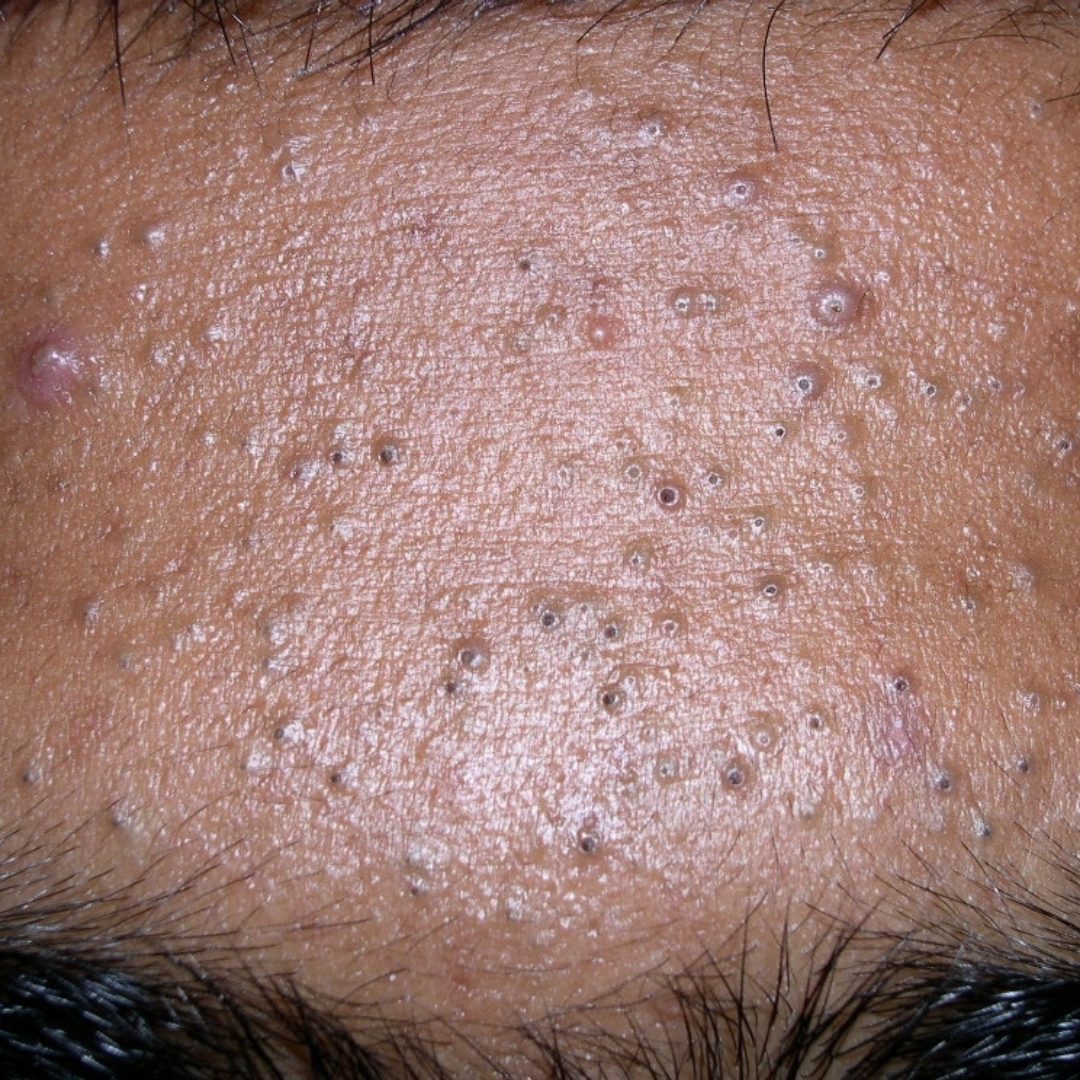 Problem Skin 101: Acne - My Beauty Nook - Ghana